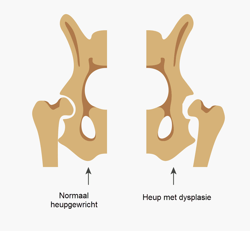 Screening op heupdysplasie - Slingeland Ziekenhuis